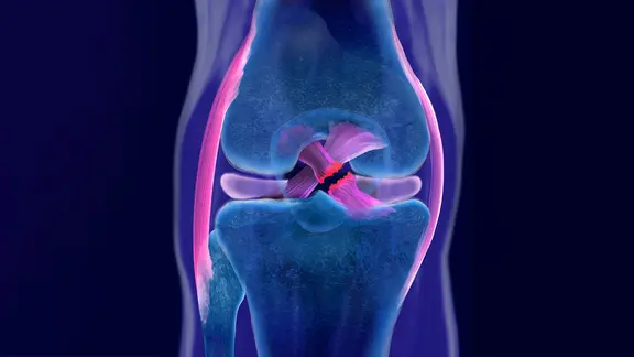 Kreuzbandriss: Symptome, Behandlung und Heilungsdauer | ndr.de