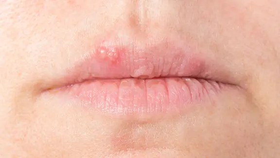 Genitalherpes: Ansteckung, Symptome und Behandlung | ndr.de