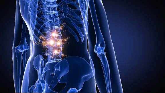 LWS-Syndrom: Ursachen, Symptome und Behandlung | ndr.de