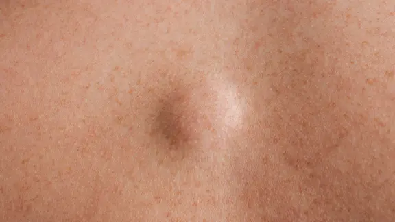 Lipom: Knubbel unter der Haut entfernen? | ndr.de