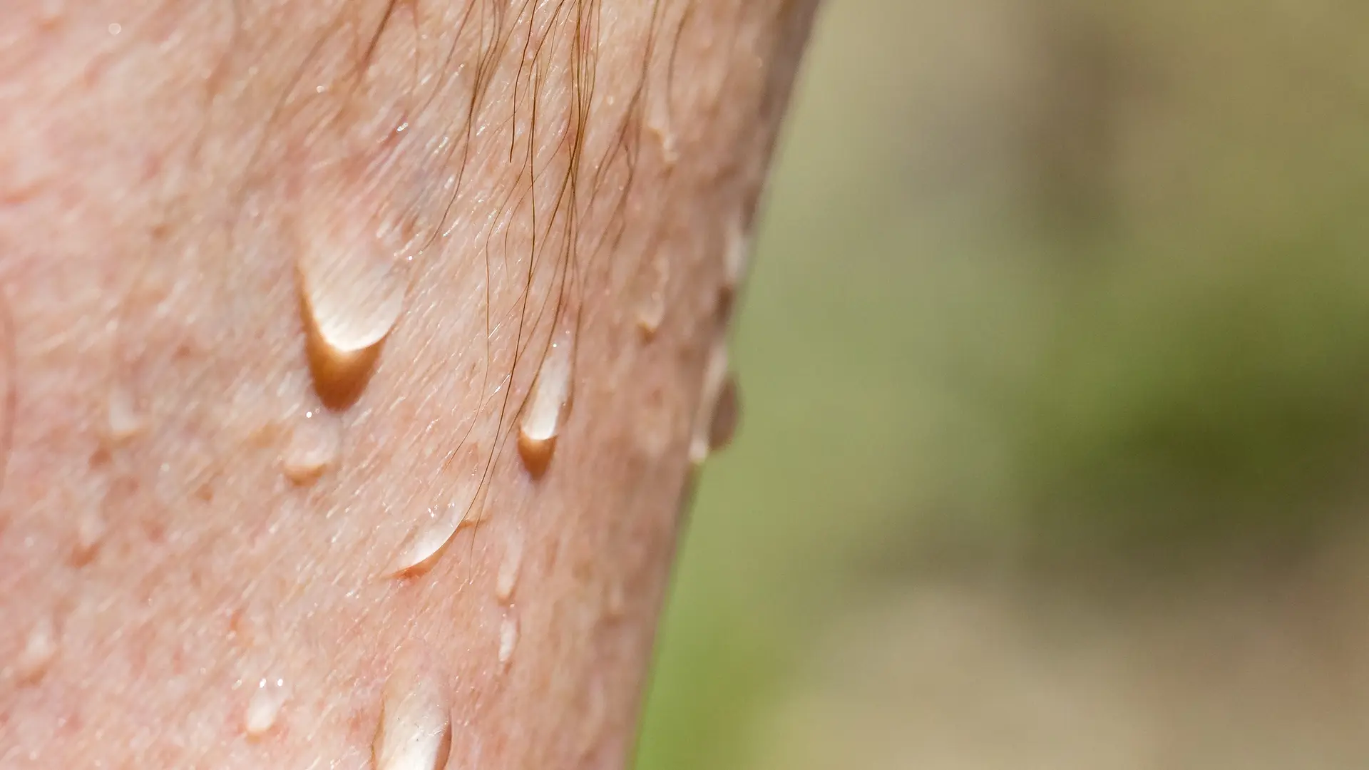 Hyperhidrose: Behandlung bei Schwitzen und Schweißausbrüchen | ndr.de