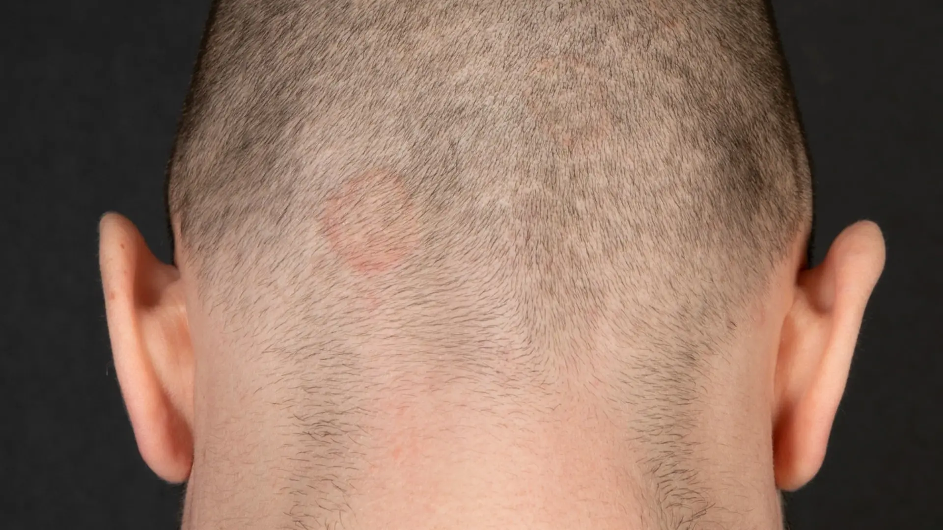 Ringelflechte: Wie gefährlich sind Hautpilze am Kopf? | ndr.de