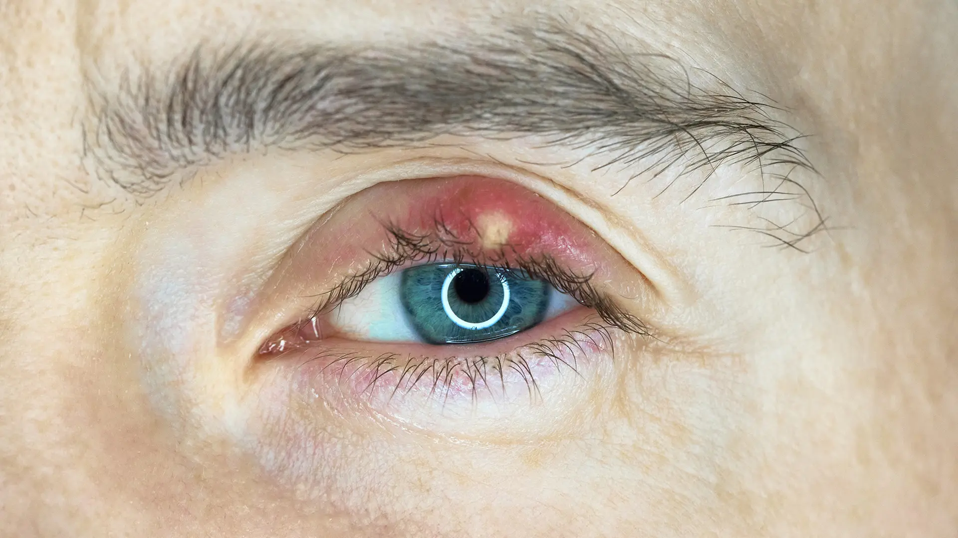 Gerstenkorn am Auge: Ursache, Ansteckung und Behandlung | ndr.de