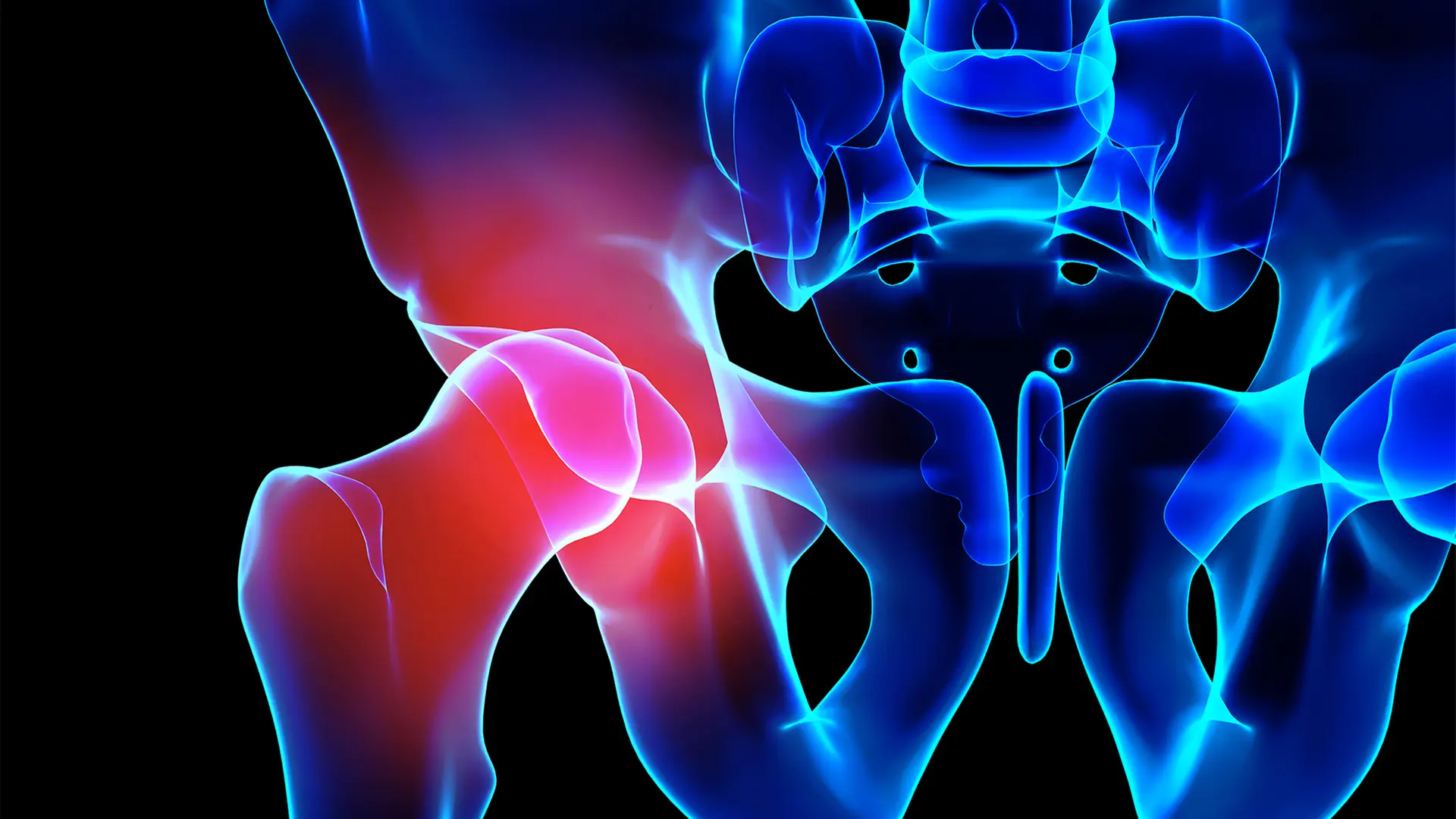 Coxarthrose: Symptome und Behandlung von Hüftarthrose | ndr.de