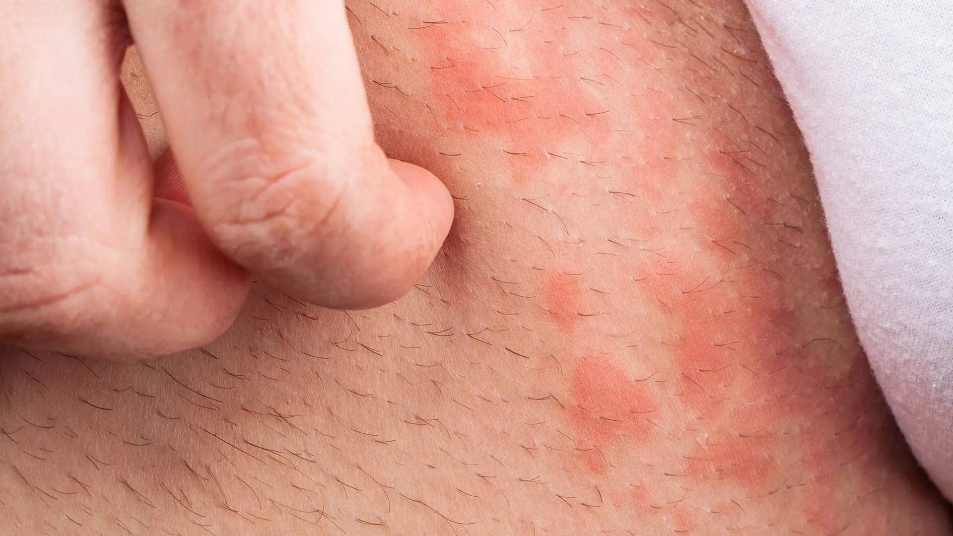 Nesselsucht: Symptome, Ursache und Behandlung | ndr.de