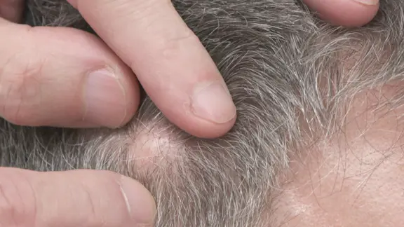 Atherom entfernen: Wie man Grützbeutel loswird | ndr.de