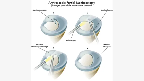 Meniskusriss: Wann ist eine OP sinnvoll? | ndr.de