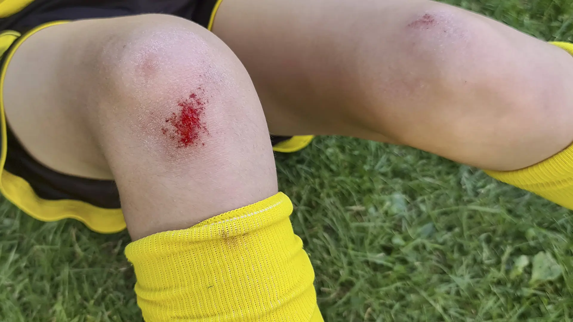 Schürfwunde behandeln: Erste Hilfe für kleine, offene Wunden | ndr.de