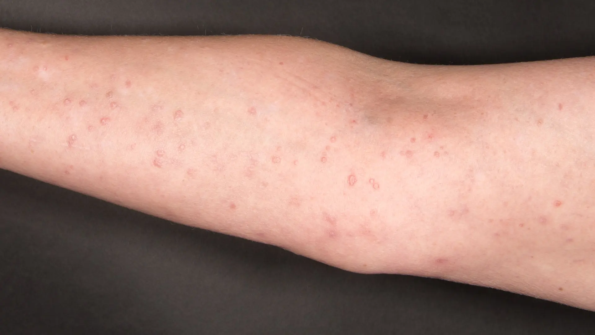 Lichen ruber oder Knötchenflechte: Diagnose und Therapie | ndr.de