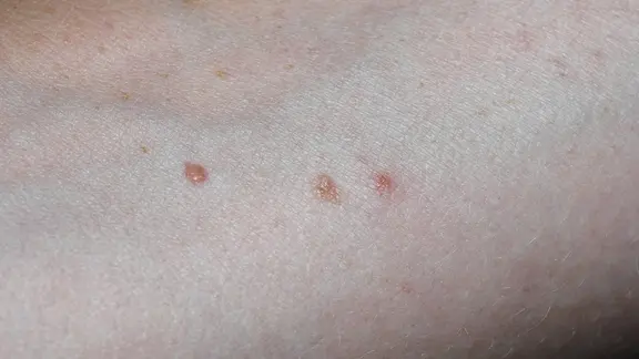 Flohbisse beim Mensch erkennen und loswerden | ndr.de