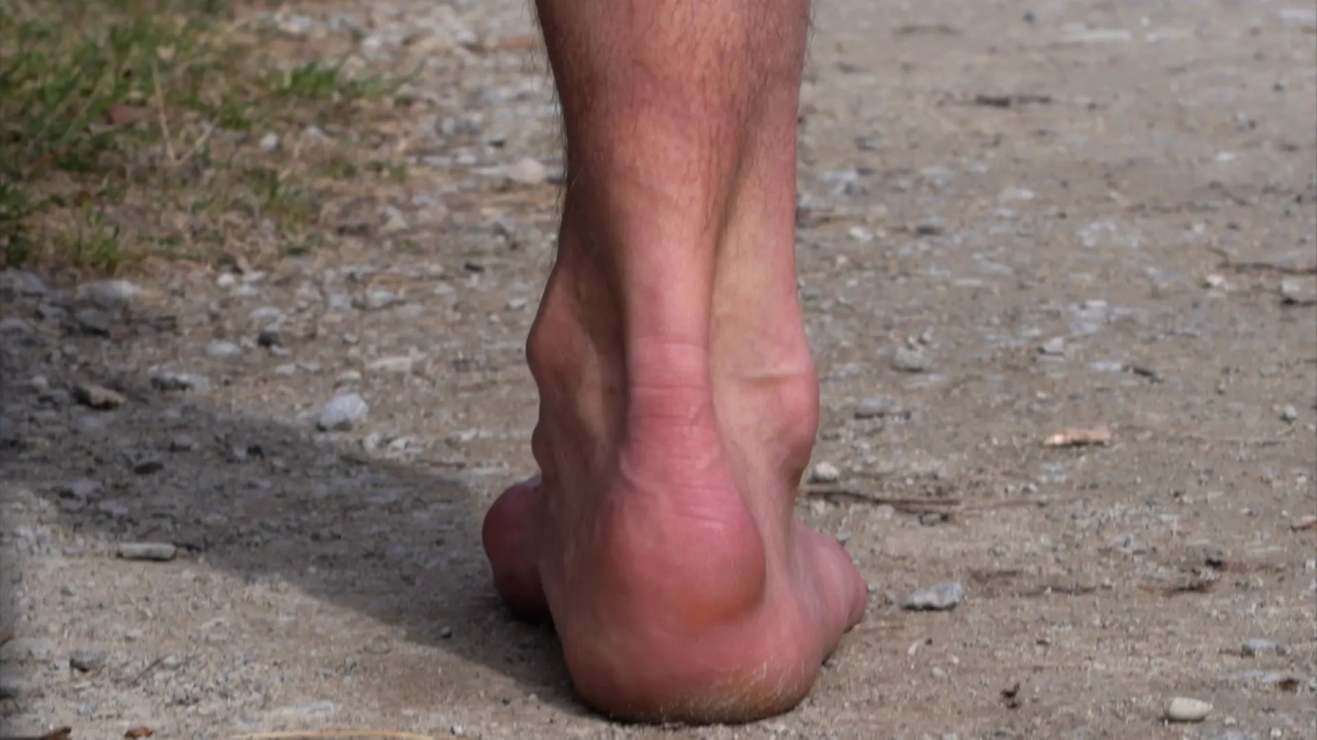 Haglundferse: Symptome, Behandlung und Ursachen | ndr.de