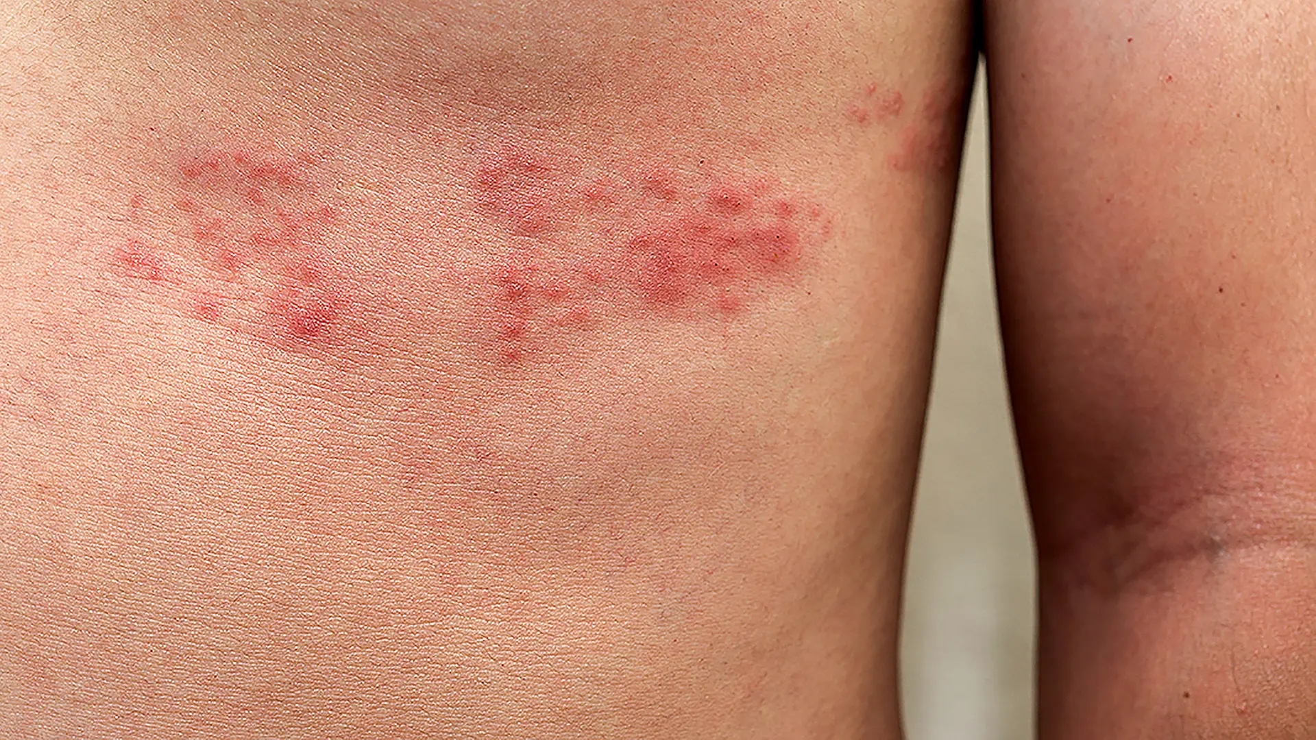 Gürtelrose (Herpes zoster): Symptome, Ansteckung, Impfung | ndr.de