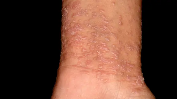 Lichen ruber oder Knötchenflechte: Diagnose und Therapie | ndr.de