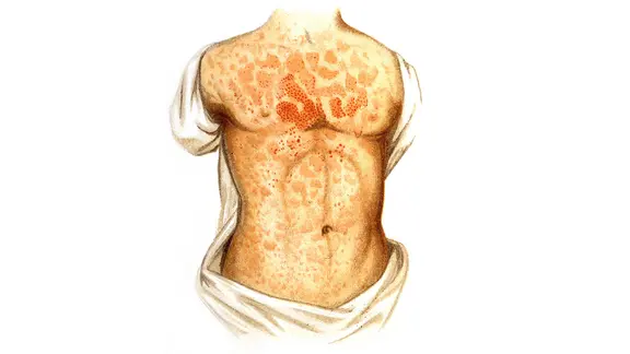 Scharlach bei Erwachsenen: Symptome, Ansteckung, Behandlung | ndr.de