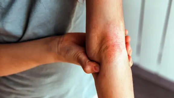 Die Haut und ihre Erkrankungen | ndr.de