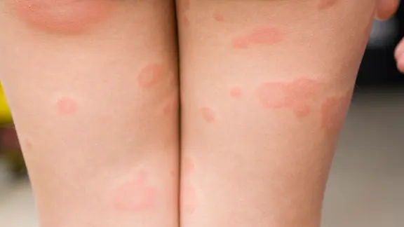 Hand-Fuß-Mund-Krankheit: Symptome, Ansteckung und Behandlung | ndr.de