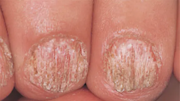 Knötchenflechte: Bilder der Erkrankung | ndr.de